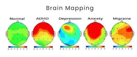 Brain Health Center Pioneering Brain Mapping And Tms Treatments To Heal Depression Anxiety