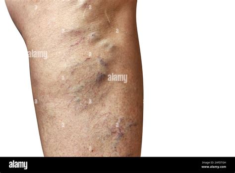 Varicose Veins On A Female Legs Phlebology Stock Photo Alamy