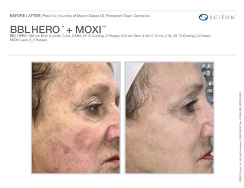 Moxi Treatment Denver CO Laser Treatment Denver CO