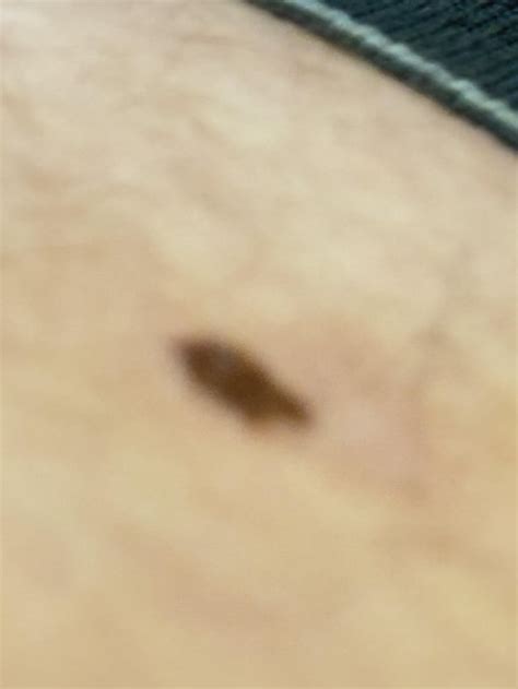 Does Anyone Know What Kinda Bug This Is Rscabies