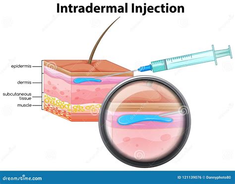 Intradermal Injection Effective Methods Of Administration Of Drugs And