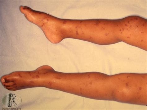Petechiae Characteristics Causes Symptoms Diagnosis And Treatments