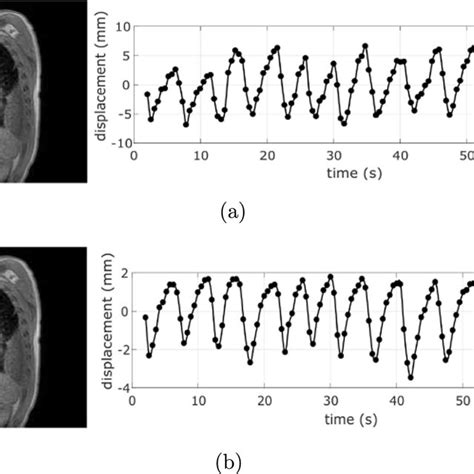 Example Of Interpolated Local Surrogate Signals For The Sagittal Download Scientific Diagram