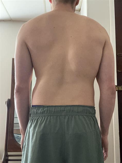 29m 56°~ Curve Thoracic 30°~ Compensatory Lumbar Curve Rscoliosis