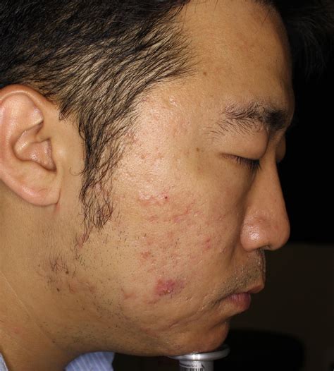 Acne04 Object Detection Model V1 2023 01 30 12 23pm By Andrei Dore