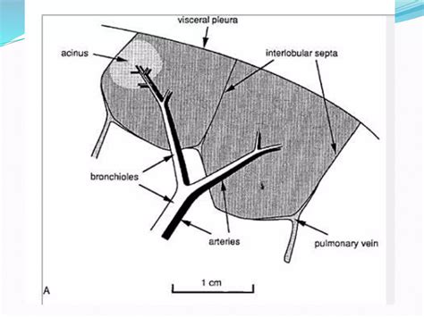 Interstitial Lung Diseases Ppt