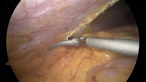 Lap Right Anterior Sectionectomy Full Version Youtube