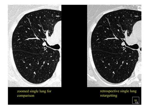 Technical Aspect Of Hrct Normal Lung Anatomy And Hrct Findings Of Lung Disease Pptx