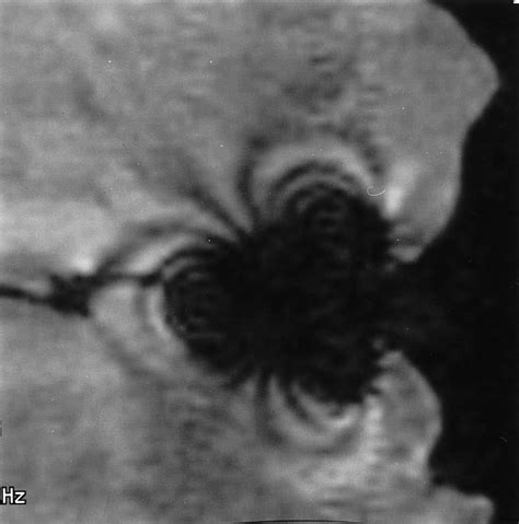 Large Susceptibility Artefact From A Conventional Ferrous Localizing Download Scientific