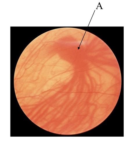 Lecture 2 Ocular Circulation Flashcards Quizlet