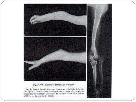 Osteocondroma Encondroma Exostosis Cartilaginosa Multiple Enfermedad