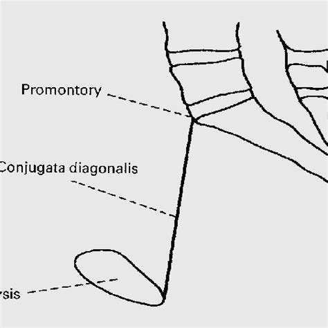 Location Of Rectosigmoid Tumor Patients Can Be Included When The Tumor Download Scientific
