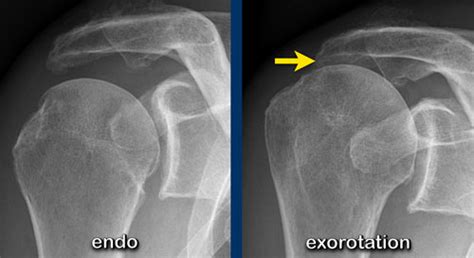 Rotator Cuff Tear X Ray