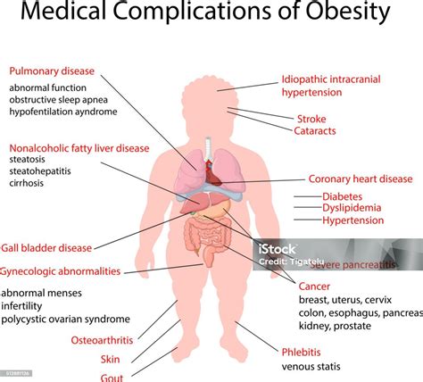 Cartoon Illustration Of Medical Complication Of Obesity Stock