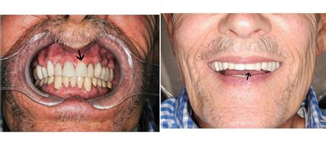 Gingivectomy Incision Procedure Gum Cutting 59 Off