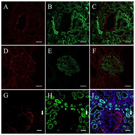 Evaluating The State Of Glomerular Disease By Analyzing Urinary