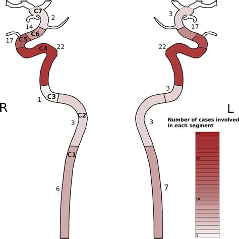 A Schematic Addition Of All Cases Of Ica Internal Carotid Artery