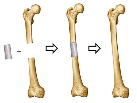 “组织工程 Tissue Engineering ”——屌爆了的再生医学 知乎