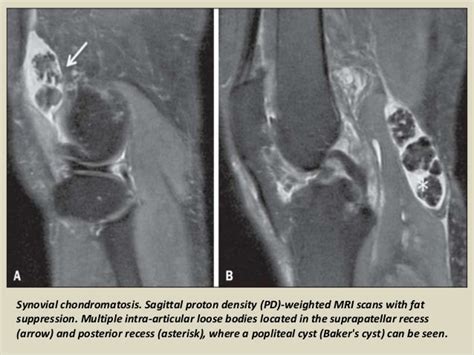 Presentation1 Radiological Imaging Of Popliteal Fossa Masses