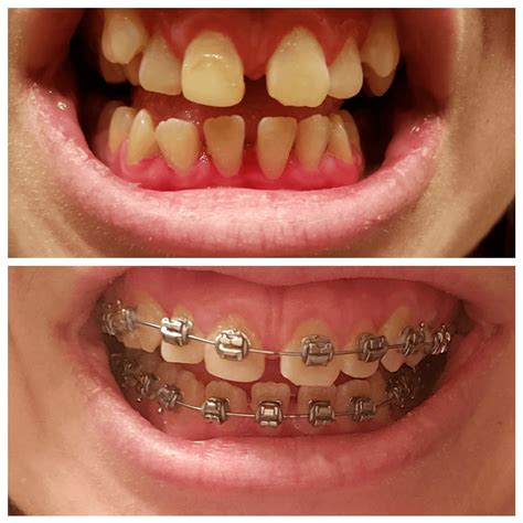 Mild Gingivitis With Braces