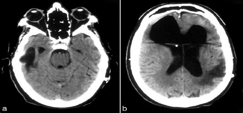 Delayed Otogenic Pneumocephalus Complicating Ventriculoperit