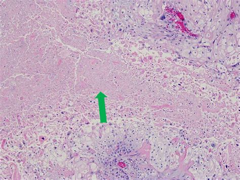 Extensive Areas Of Tumor Necrosis Are Identified Green Arrow
