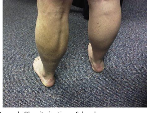 Figure 1 From New Classification Criteria For Systemic Sclerosis Scleroderma Semantic Scholar