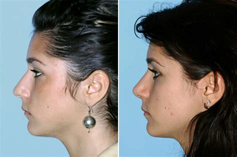 Managing Congestion After Rhinoplasty Surgery
