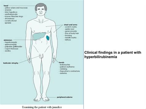 Hyperbilirubinemia Final Pptx