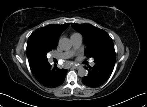 Calcification Of Lymph Nodes