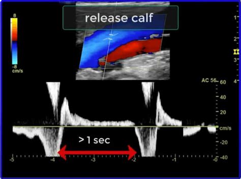 Deep Vein Thrombosis Ultrasound Criteria And Diagnostic Skills For