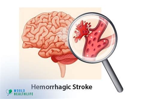 Types Of Stroke Explained Symptoms And Treatment
