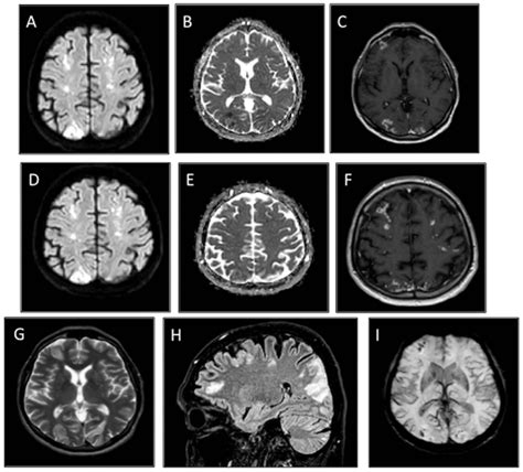 Baseline Brain Mri A C Multiple Patchy Foci Of Diffusion Restriction