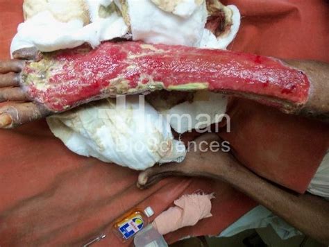 Cellulitis Wound Care Collagen Particle Healing Products Uses