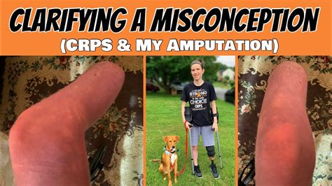 Clearing Things Up Crps And My Amputation Youtube