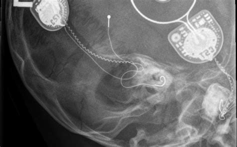 Bilateral Cochlear Implant Buyxraysonline