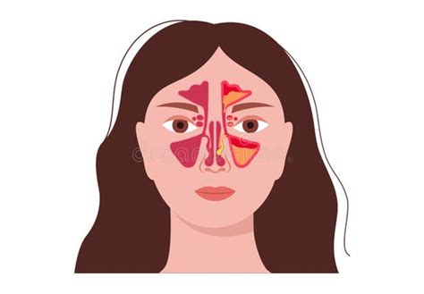 Nasal Polyps Poster Stock Illustration Illustration Of Pathology