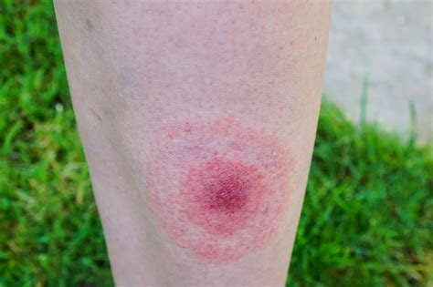 Nhs Warns Of Lyme Disease Symptoms That Can Last For Years After