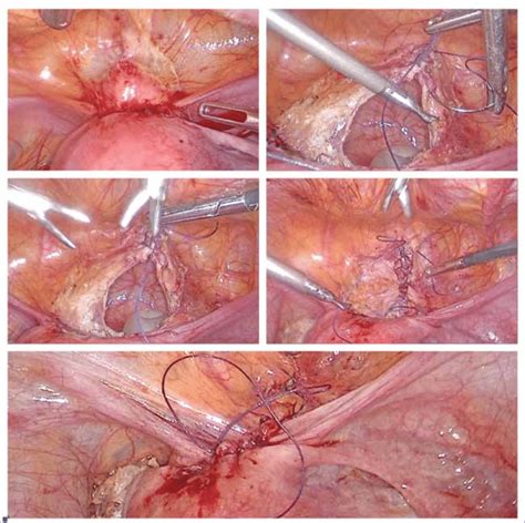 Bladder Endometriotic Nodule Laparoscopic Resection And Suture Download Scientific Diagram
