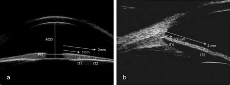 Details Of Measurement Of The Anterior Chamber Parameters A Iris