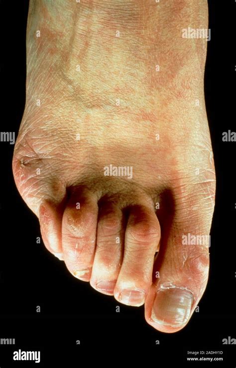 Hammer Toes This Is A Condition In Which Some Toes The Middle Three