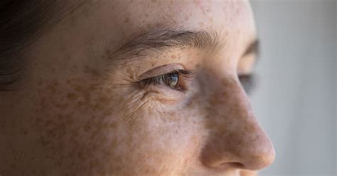 Causes Of Hyperpigmentation Skin Concern Chart
