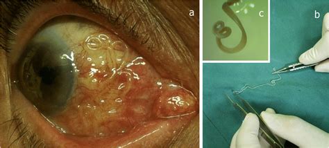 Adirofilaria Roundworm In Nasal Sub Conjunctival Space In The Right Eye Download Scientific