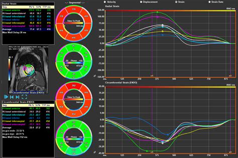 Lv Strainmodule2 Medisimaging