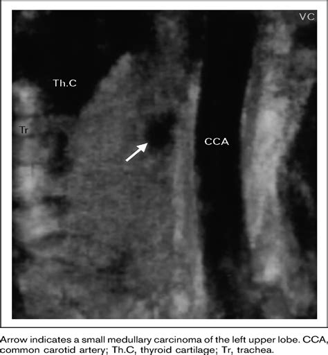 Minimally Invasive Thyroidectomy Current Opinion In Oncology