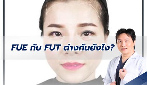 Fue กับ Fut ต่างกันยังไง หมอหมู ปลูกผม
