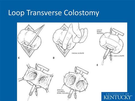 Ppt The Difficult Stoma Powerpoint Presentation Id257323
