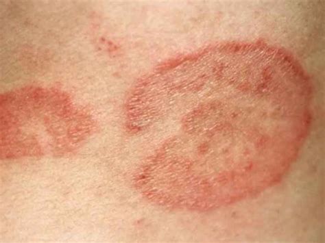 Ringworm Rashes Causes And Treatments Remotederm