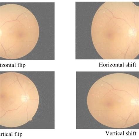Cataract Grading Accuracy In Terms Of Data Augmentation Download Scientific Diagram