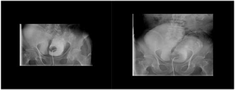 An Voiding Cystourethrography Revealed That On The Right Side Of The Download Scientific